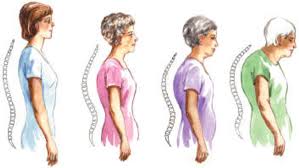 Physical Therapy Spotlight: Are you Shrinking? - WestsideToday